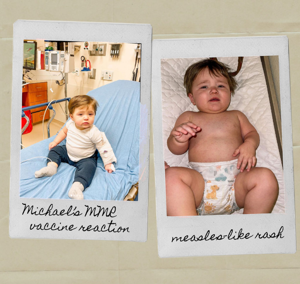 Measles Rash And High Fever After MMR Vaccine